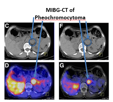Pheochromocytoma and Paraganglioma Symptoms and Treatment | Saint John ...