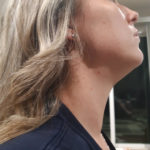 Thyroid Radiofrequency Ablation | John Wayne Cancer Institute