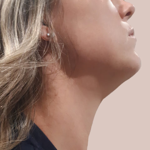 Thyroid Radiofrequency Ablation | Saint John’s Cancer Institute