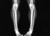 Parathyroid Disease and Hyperparathyroidism (Hypercalcemia) | Saint ...