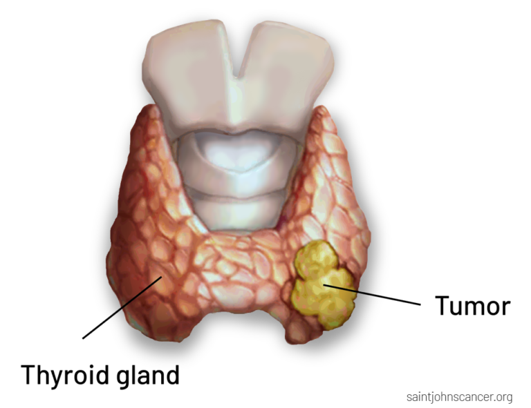 Thyroid Cancer Symptoms Diagnosis Surgery Treatment And Prognosis