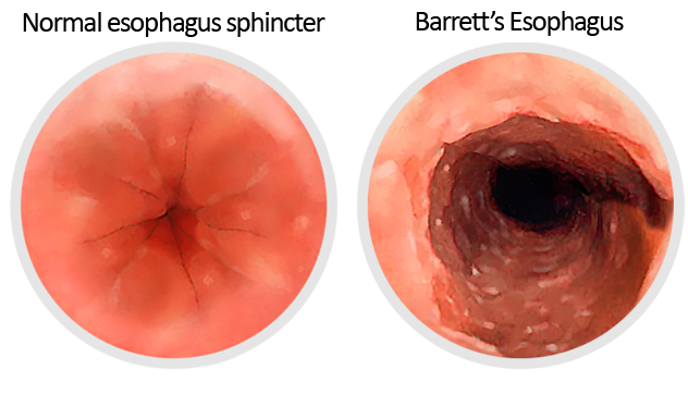 Esophagus And Stomach Cancer Symptoms Diagnosis And Treatment Saint Johns Cancer Institute