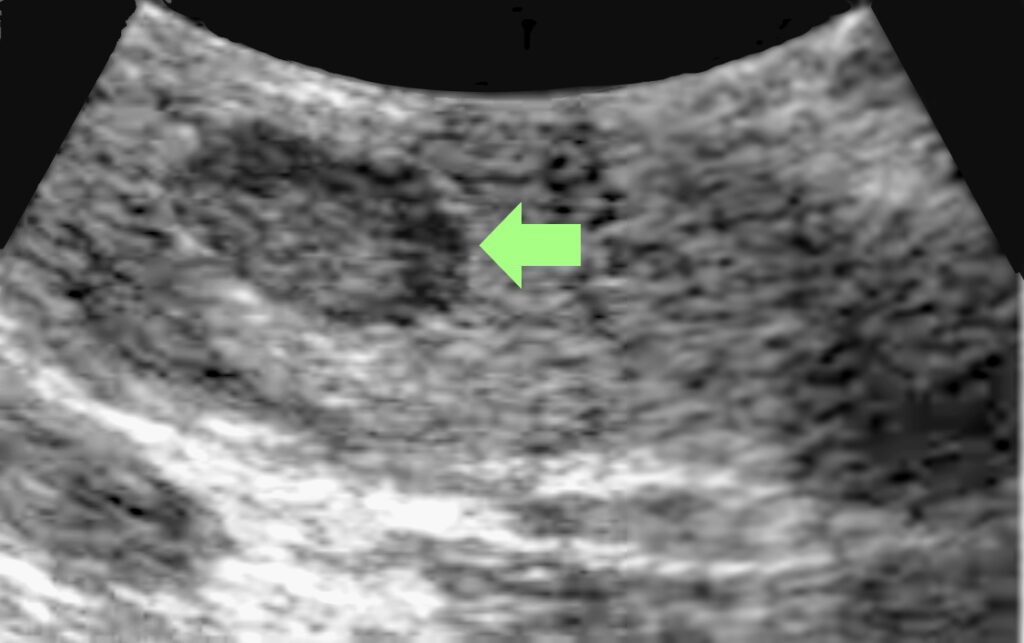 Pancreatic Cancer Symptoms, Diagnosis, and Treatment | Saint John’s ...