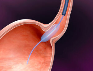 Benign Esophageal Disease Treatment - Saint John’s Cancer Institute
