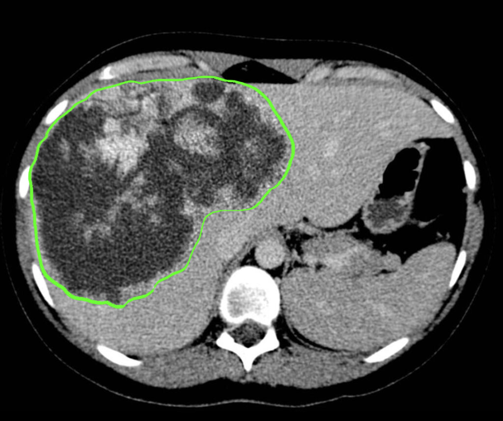 Liver Cancer Risk Factors, Symptoms, and Prevention | Saint John’s ...