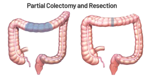 Colorectal Cancer Treatment Options | Saint John’s Cancer Institute