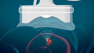 Histotripsy for Liver Tumors - Saint John’s Cancer Institute