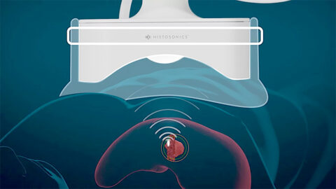 Histotripsy for Liver Tumors - Saint John’s Cancer Institute