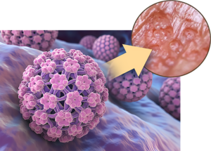 Cervical Cancer Causes, Signs and Symptoms, and Stages | Saint John’s ...