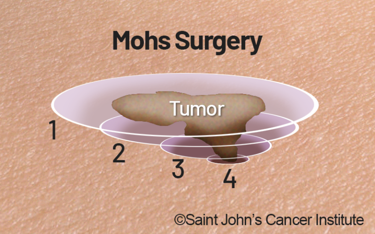 Squamous Cell Carcinoma (SCC) Symptoms, Stages, Risk Factors and ...