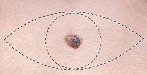 Wide Local Excision for Early Melanoma Treatment | Saint John’s Cancer ...