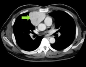 Mediastinal Tumor (Mass): Symptoms, Diagnosis and Stages | Saint John’s ...