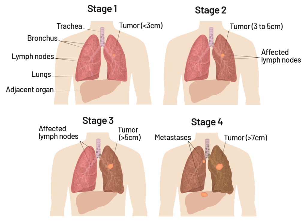 Lung Cancer Symptoms Risk Factors Diagnosis And Treatment Saint Johns Cancer Institute