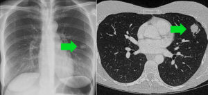 Tuberculosis - Saint John’s Cancer Institute