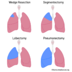 Lung Cancer Treatment Options & Recovery | Saint John’s Cancer Institute