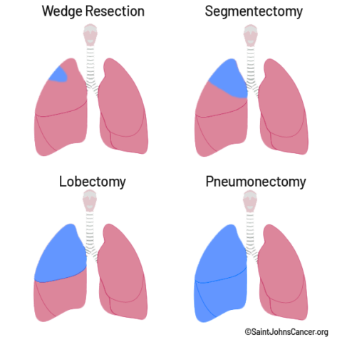 Lung Cancer Treatment Options & Recovery | Saint John’s Cancer Institute
