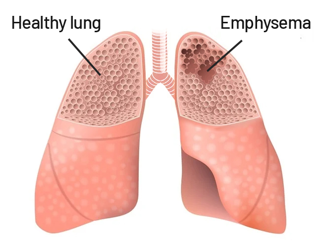 Lung Volume Reduction Surgery (LVRS) for Emphysema | Saint John’s ... Lung Volume Reduction Surgery (LVRS) for Emphysema | Saint John’s ...
