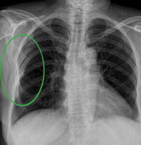 Chest Wall Conditions - Saint John’s Cancer Institute