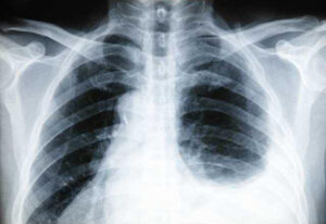 Chest Wall Conditions - Saint John’s Cancer Institute