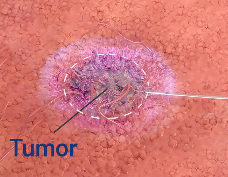 Bronchoscopic Pulsed Electric Field (PEF) Ablation for Lung Tumors ...