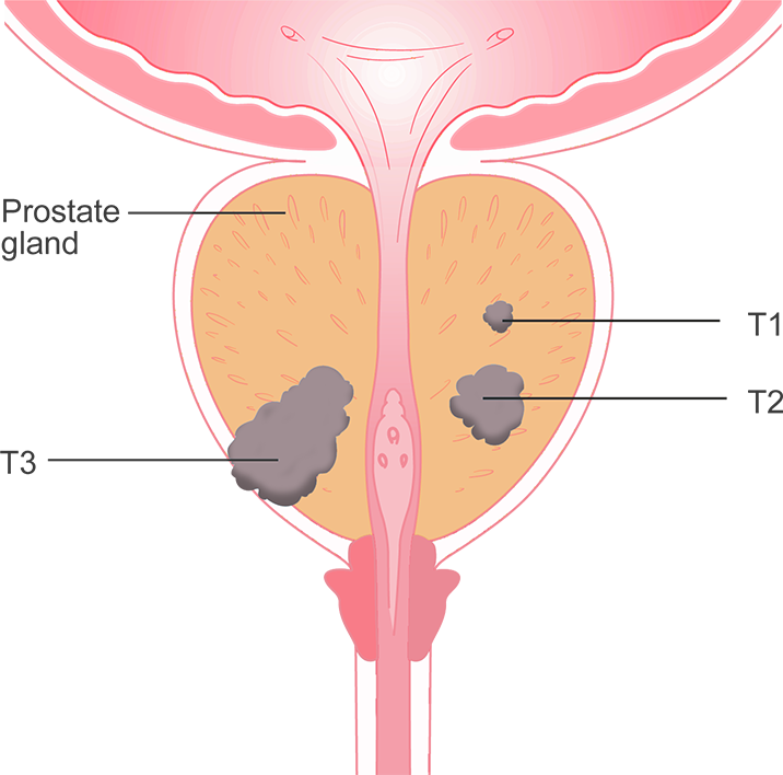 Prostate Cancer Signs Symptoms Risk Factors And Diagnosis Saint
