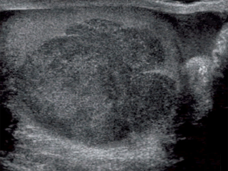 Testicular Cancer: Signs, Symptoms, Risk Factors, Stages and Diagnosis ...