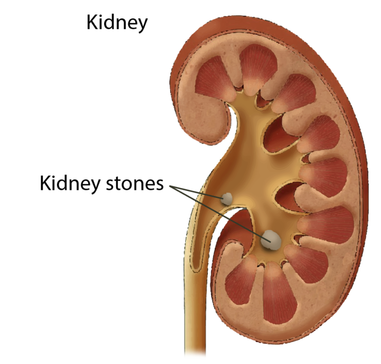 Kidney Stones Symptoms, Risk Factors, and Diagnosis | Saint John’s ...