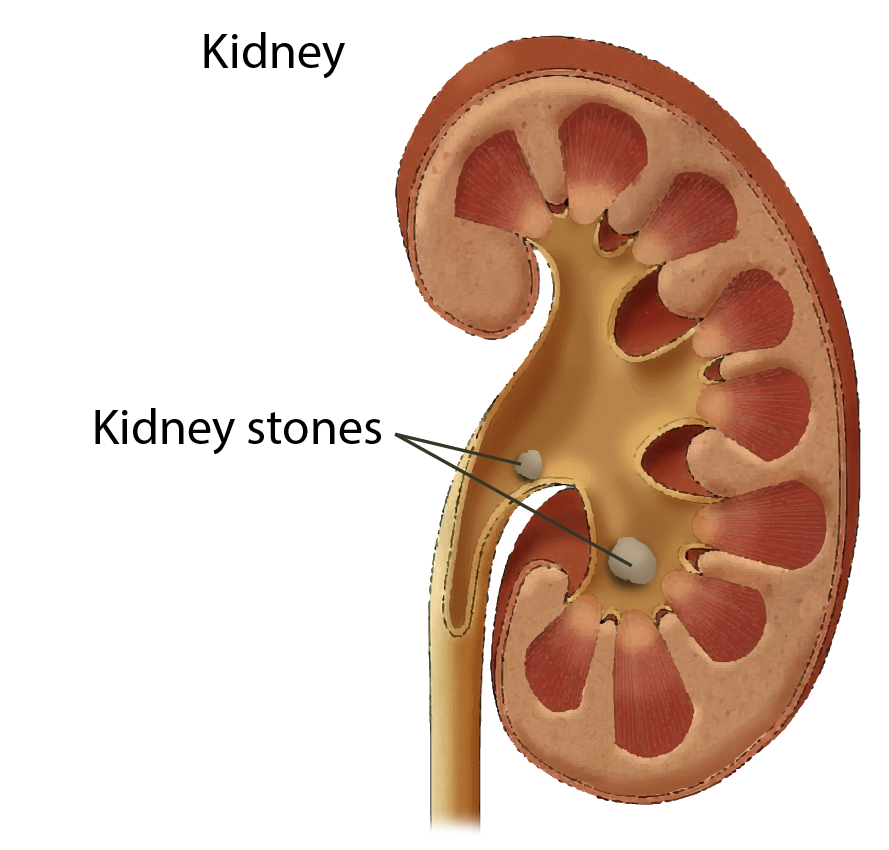 Kidney Stones Symptoms Risk Factors And Diagnosis Saint John s