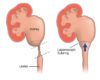 Urinary Obstruction and Ureteral Stricture: Causes and Treatment