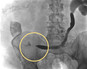 Urinary Obstruction and Ureteral Stricture: Causes and Treatment