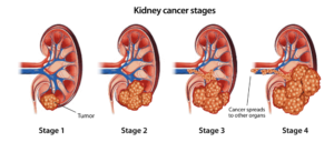 Kidney Cancer Treatment (Renal Cancer) Signs and Symptoms | Saint John ...