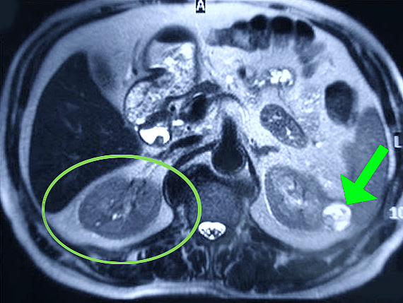 Ct Scan Of Kidney Tumor