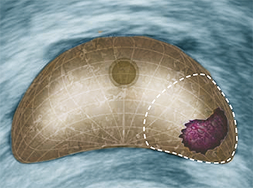 HIFU for Prostate Cancer - Saint John’s Cancer Institute - Santa Monica, CA